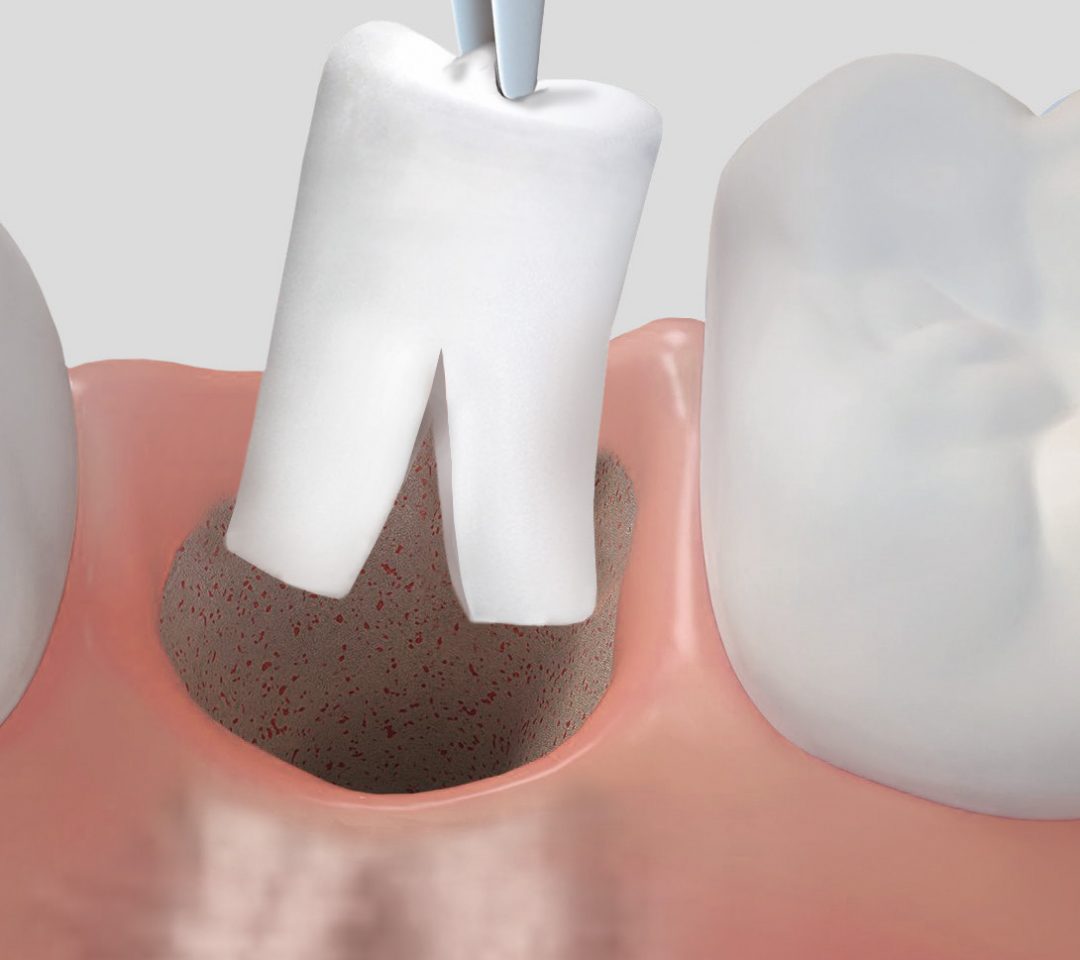 Germany > Dental > Allgemeine Oralchirurgie - RESORBA®