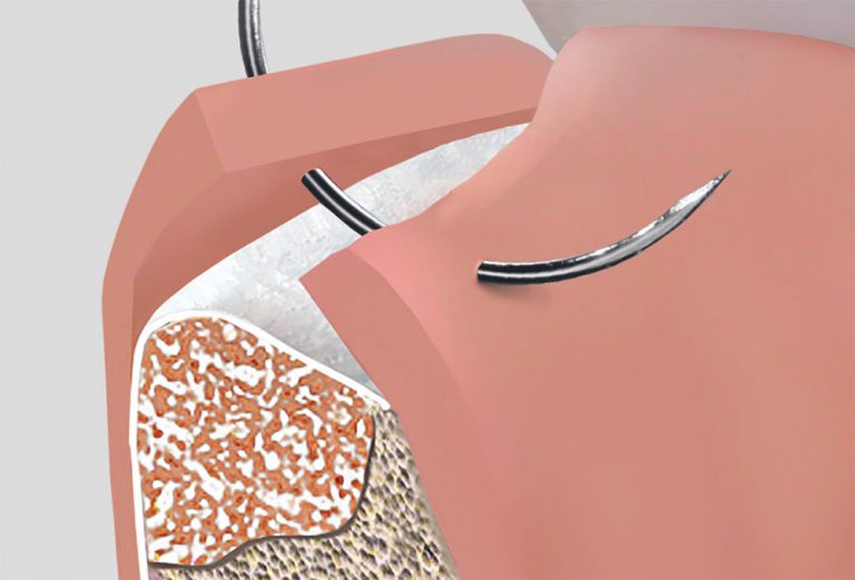 Germany > Dental > Knochenregeneration - RESORBA®